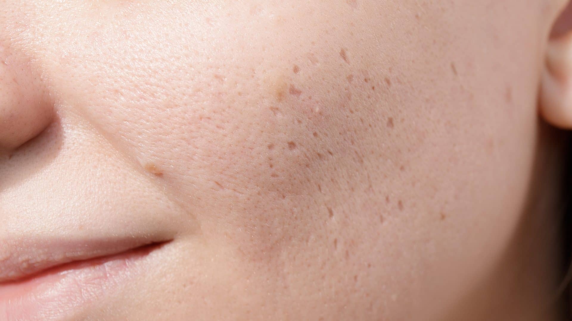 Scar Treatment Perth | Scarring Removal & Reduction | Luxe Medical ...